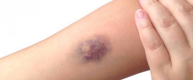 What Causes Blue Spots Under the Skin? | Waradana