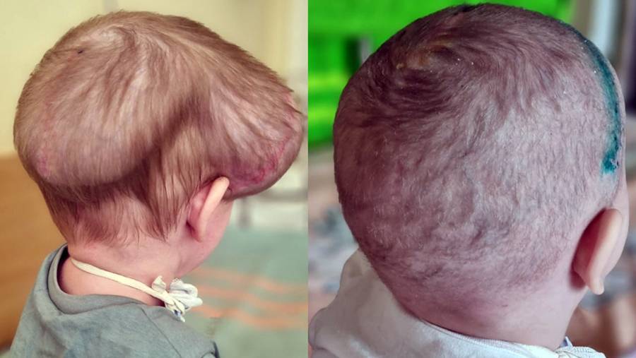 Successful Surgery to Remove Major Deformity from a Girl's Head | Waradana